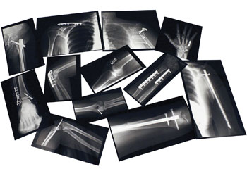 Broken & Fixed Bones Kit - MTA Catalogue